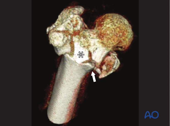 Intertrochanteric fractures