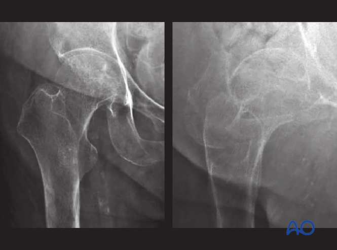 Assessment of patients with a proximal femoral fracture