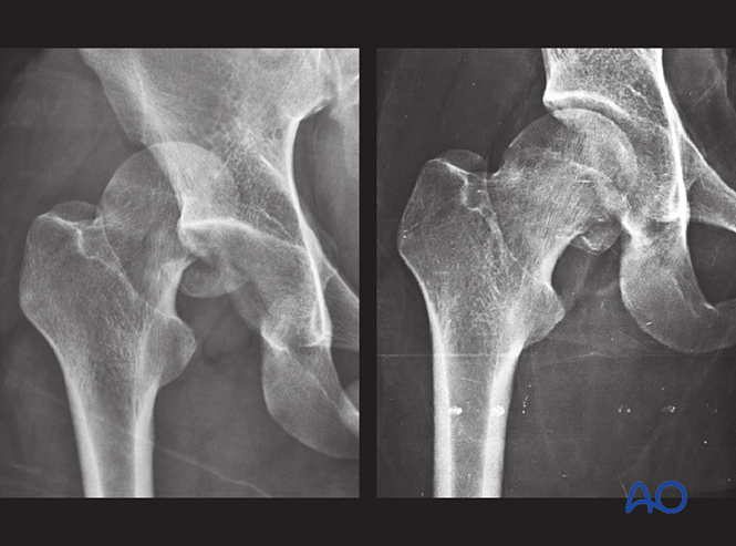 Assessment of patients with a proximal femoral fracture