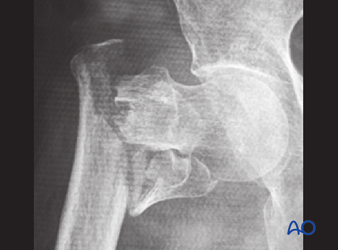 Assessment of patients with a proximal femoral fracture