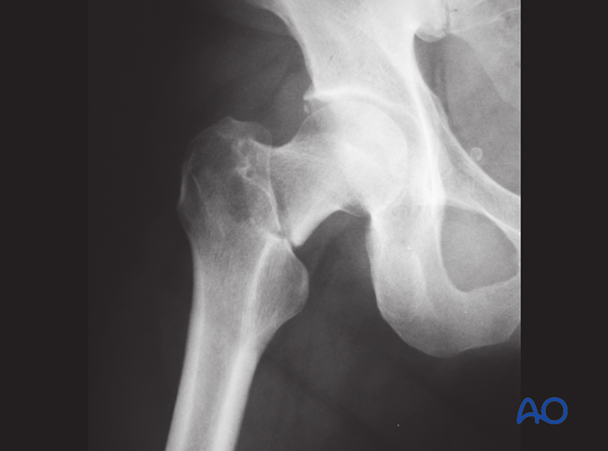Complications and technical failures in femoral neck fracture management