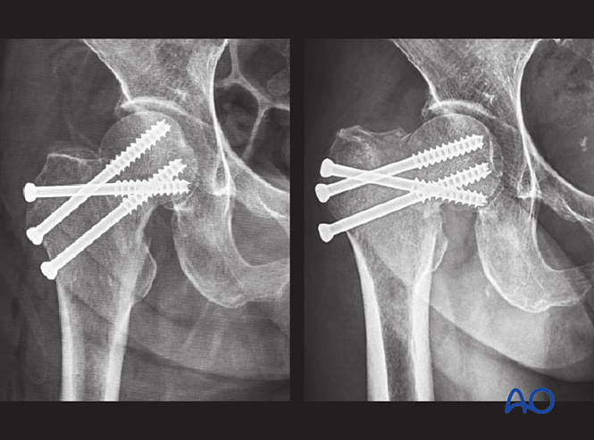 Complications and technical failures in femoral neck fracture management