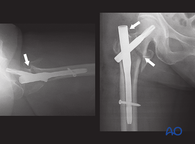 Complications and technical failures in trochanteric fracture management