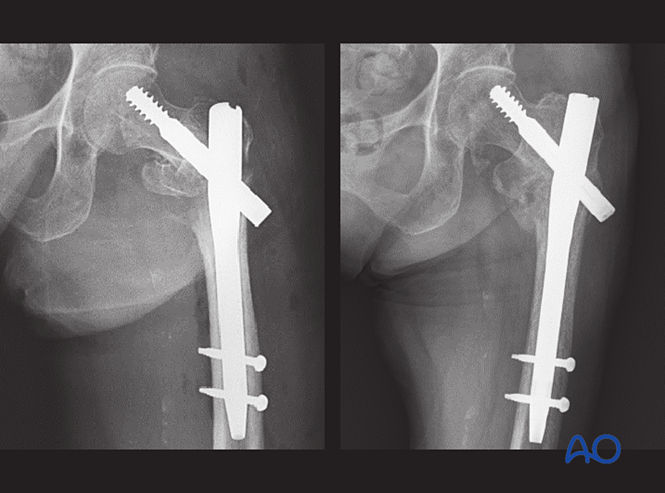Complications and technical failures in trochanteric fracture management