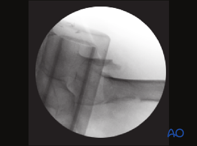 Assessment of reduction quality (trochanteric fractures)