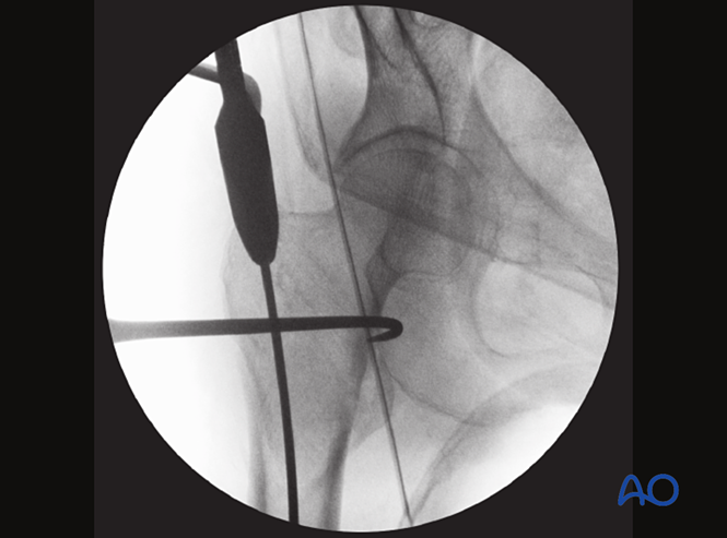 Percutaneous reduction techniques (trochanteric fractures)
