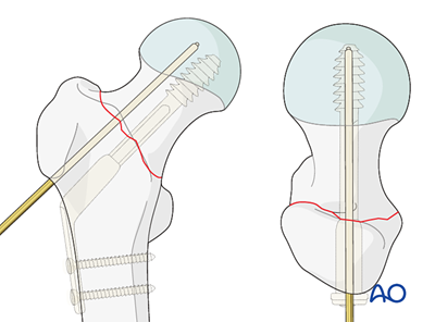Percutaneous reduction techniques (trochanteric fractures)