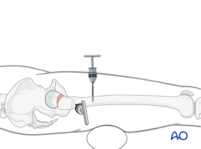 Percutaneous reduction techniques (femoral neck fractures)