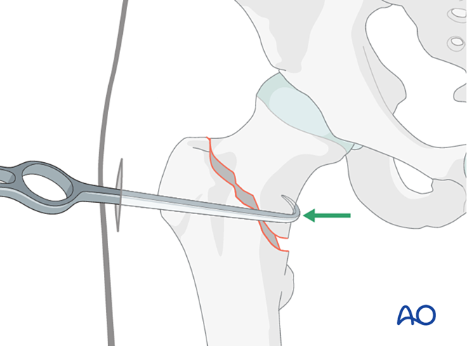 Percutaneous reduction techniques (femoral neck fractures)