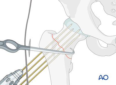 Percutaneous reduction techniques (femoral neck fractures)