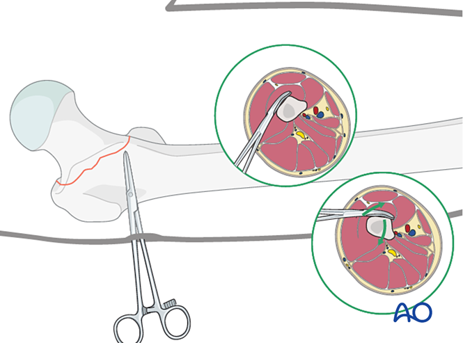 Percutaneous reduction techniques (femoral neck fractures)