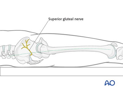 Antegrade nailing approach to the femoral shaft with piriformis entry point
