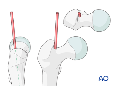 Antegrade nailing approach to the femoral shaft with piriformis entry point