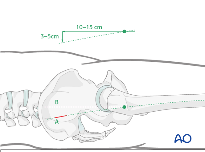 Antegrade nailing approach to the femoral shaft with piriformis entry point