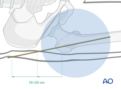 Antegrade nailing approach to the femoral shaft with trochanteric entry ...