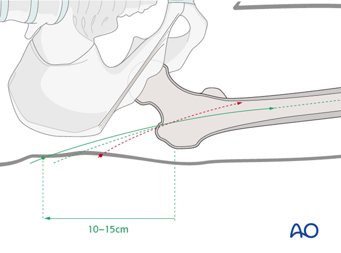 Antegrade nailing approach to the femoral shaft with piriformis entry point