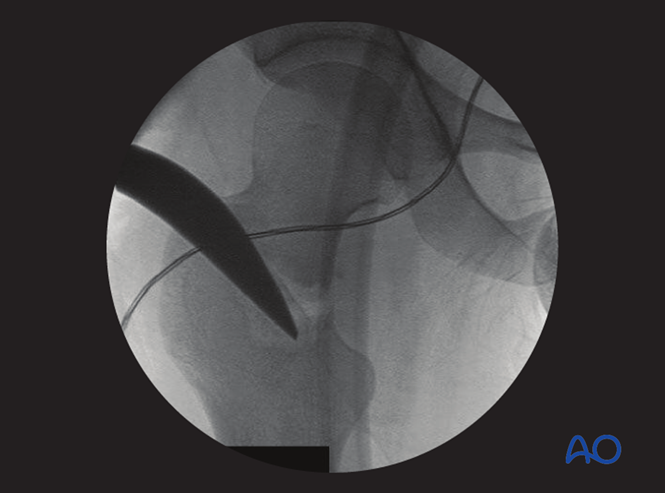 Antegrade nailing approach to the femoral shaft with piriformis entry point