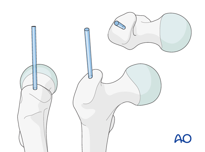 Antegrade nailing approach to the femoral shaft with trochanteric entry ...