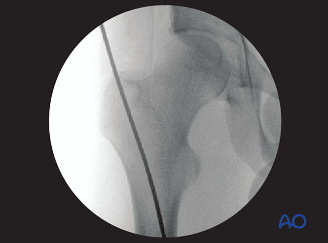 Antegrade nailing approach to the femoral shaft with trochanteric entry ...