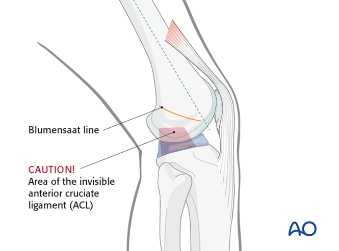 Retrograde nailing approach to the femoral shaft