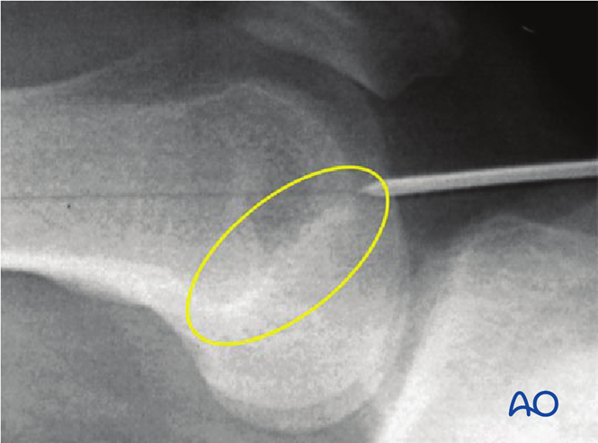 Retrograde nailing approach to the femoral shaft