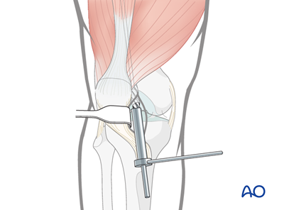 Retrograde nailing approach to the femoral shaft