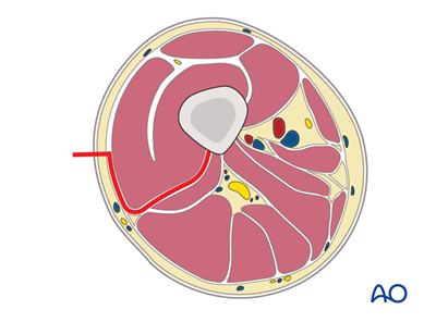 Lateral approach to the femoral shaft