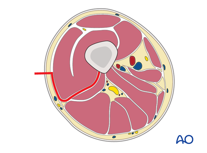 Lateral approach to the femoral shaft