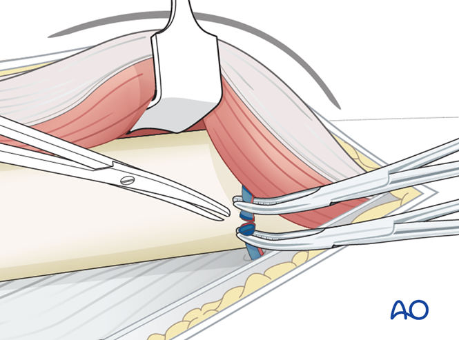 Lateral approach to the femoral shaft