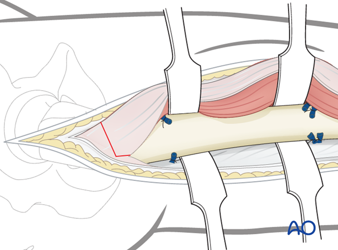Lateral approach to the femoral shaft