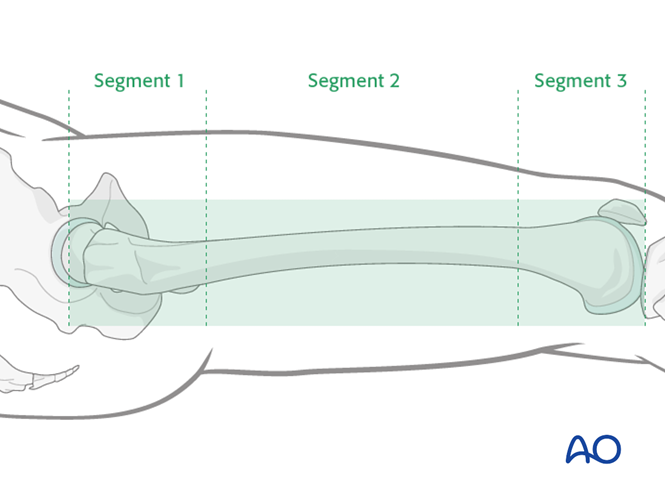 Minimally invasive osteosynthesis approach to the femoral shaft