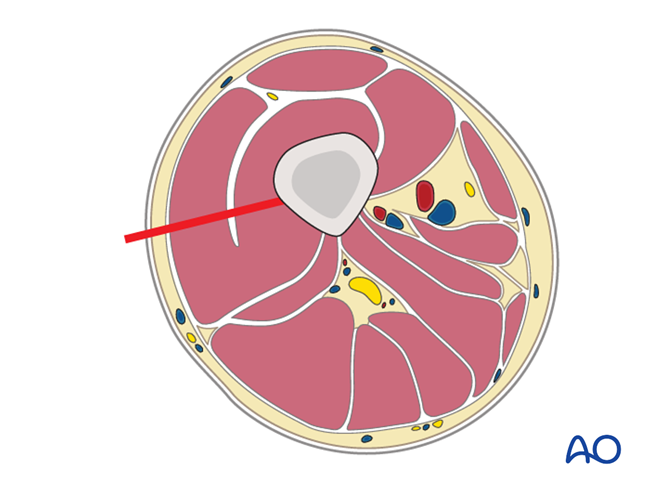 Minimally invasive osteosynthesis approach to the femoral shaft
