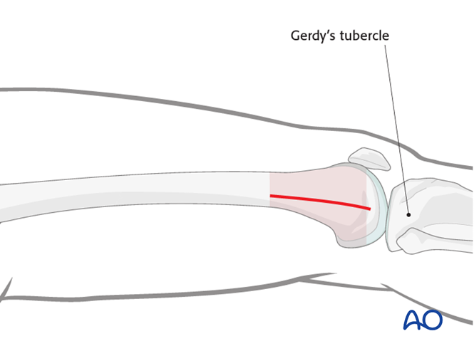 Minimally invasive osteosynthesis approach to the femoral shaft