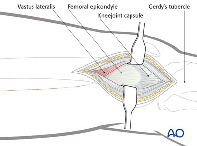 Minimally invasive osteosynthesis approach to the femoral shaft