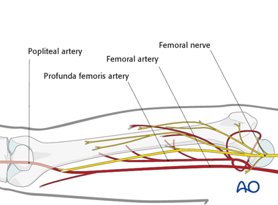 Locations for pin placement in the femur