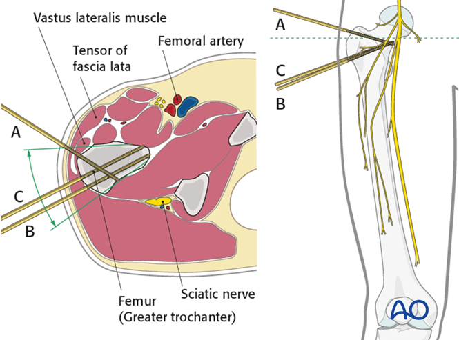 Locations for pin placement in the femur