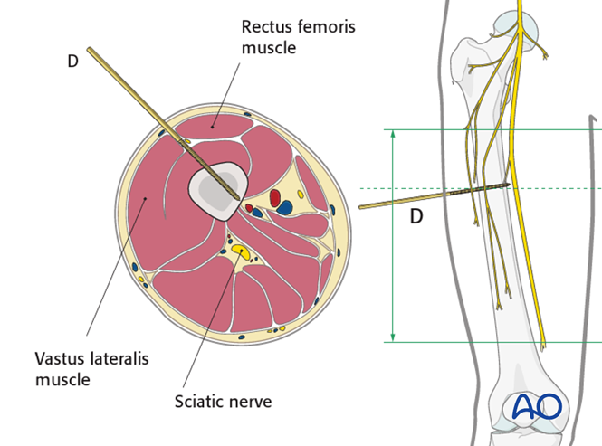 Locations for pin placement in the femur