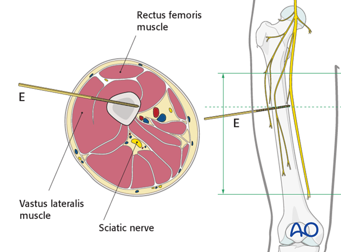 Locations for pin placement in the femur