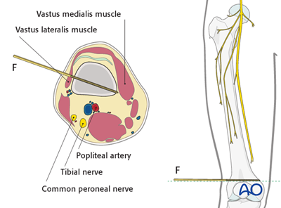 Locations for pin placement in the femur