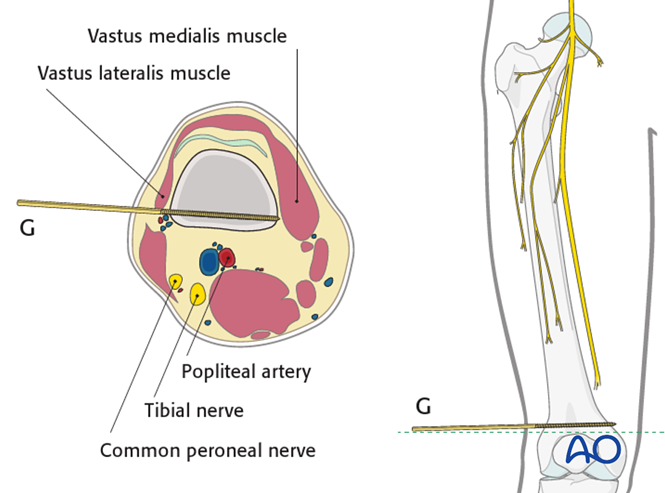 Locations for pin placement in the femur