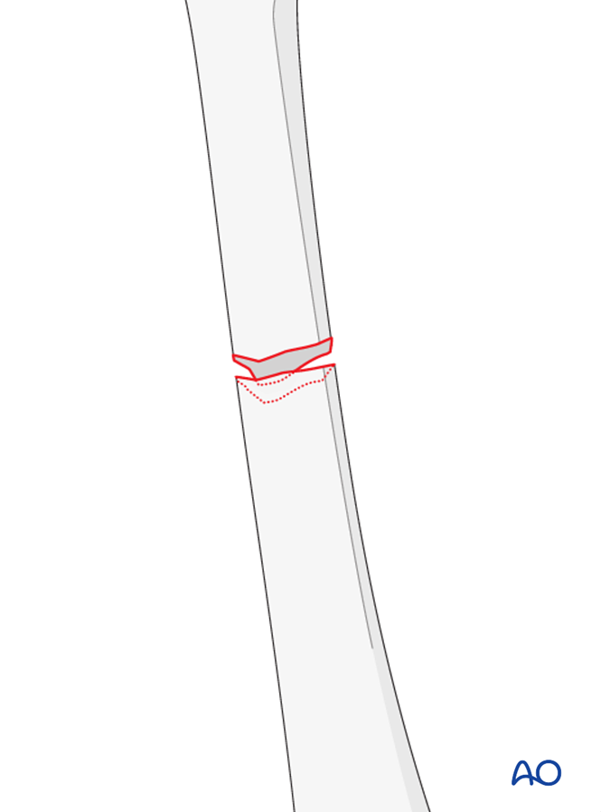 Simple, transverse, middle 1/3 fractures