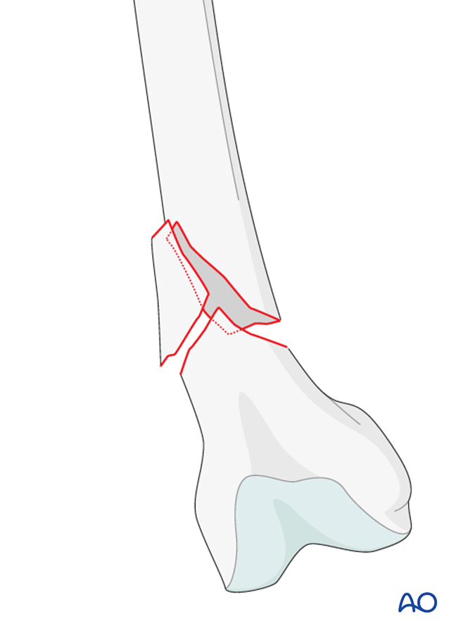 Wedge, intact, distal 1/3 fractures