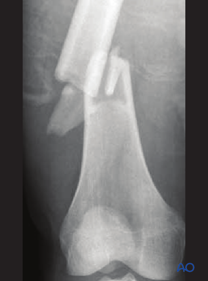 Wedge, intact, distal 1/3 fractures
