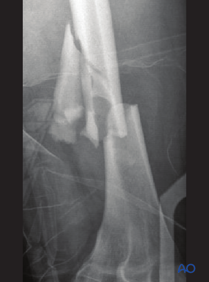 Wedge, fragmentary, distal 1/3 fractures