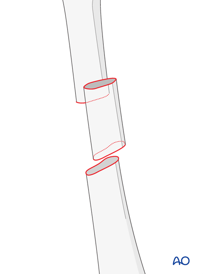 Segmental, intact, middle 1/3 fractures
