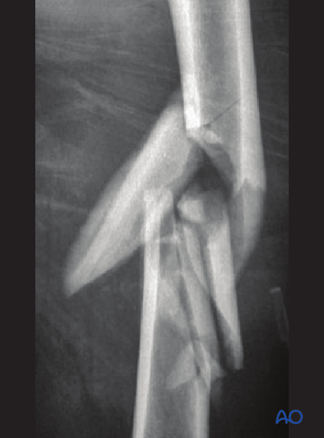 Segmental, fragmentary, middle 1/3 fractures