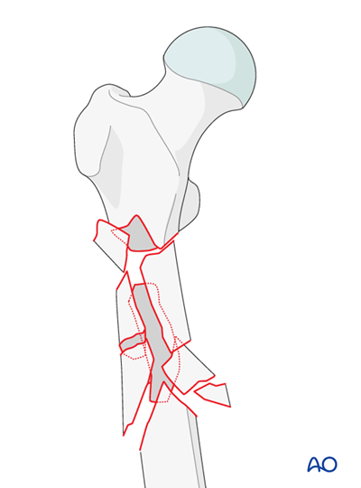 Segmental, fragmentary, proximal 1/3 fractures