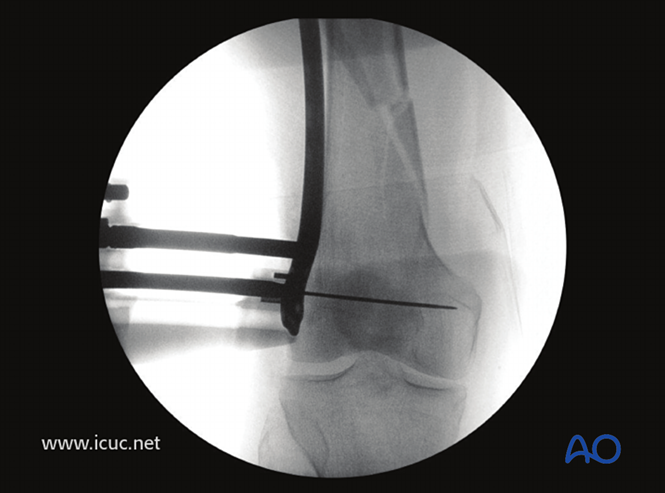 MIO - Bridge plating (LISS or LCP) for Wedge, fragmentary, distal 1/3 ...