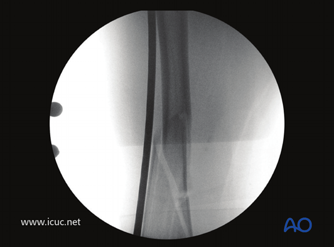 MIO - Bridge plating (LISS or LCP) for Wedge, fragmentary, distal 1/3 ...