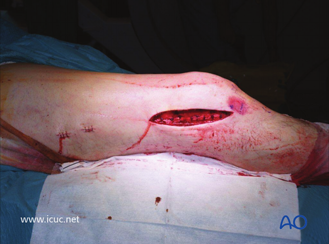 MIO - Bridge plating (LISS or LCP) for Wedge, fragmentary, distal 1/3 ...